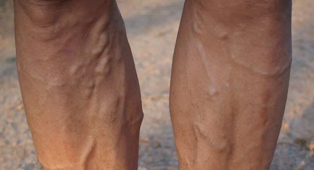 5 мифов о варикозе